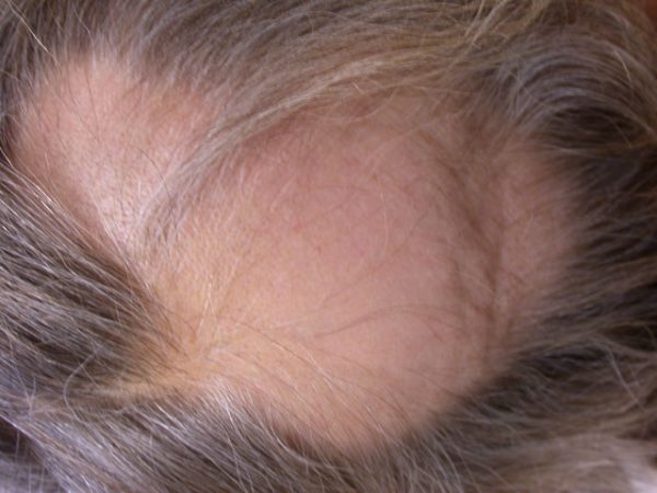 Alopecia Areata - Patchy Hair Loss